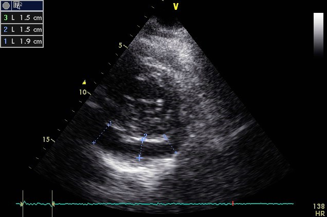 Diagnosis of acute pericarditis